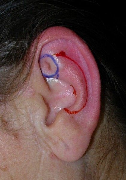 Triangular Fossa Piercing